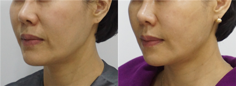 Before and After - Haru Clinic