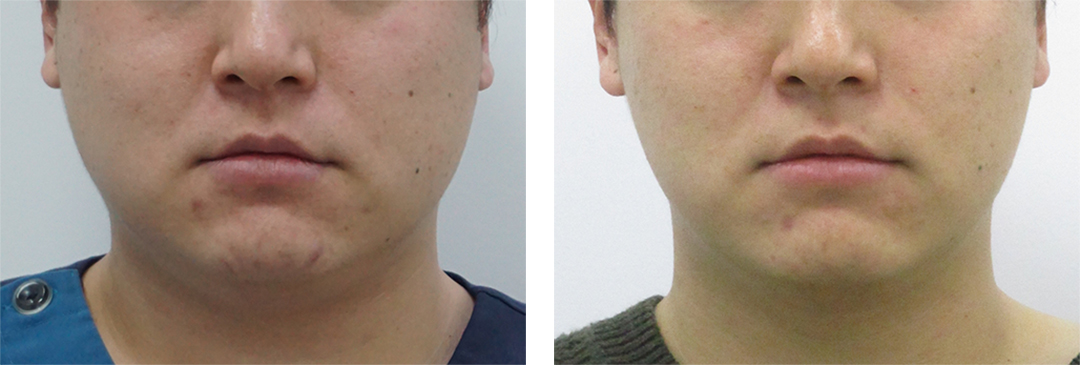 V Line Injection in Korea - Haru Clinic in Gangnam, South Korea