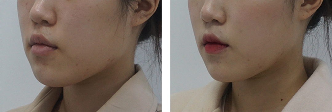 V Line Injection in Korea - Haru Clinic in Gangnam, South Korea