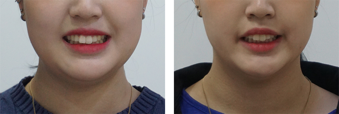 V Line Injection in Korea - Haru Clinic in Gangnam, South Korea