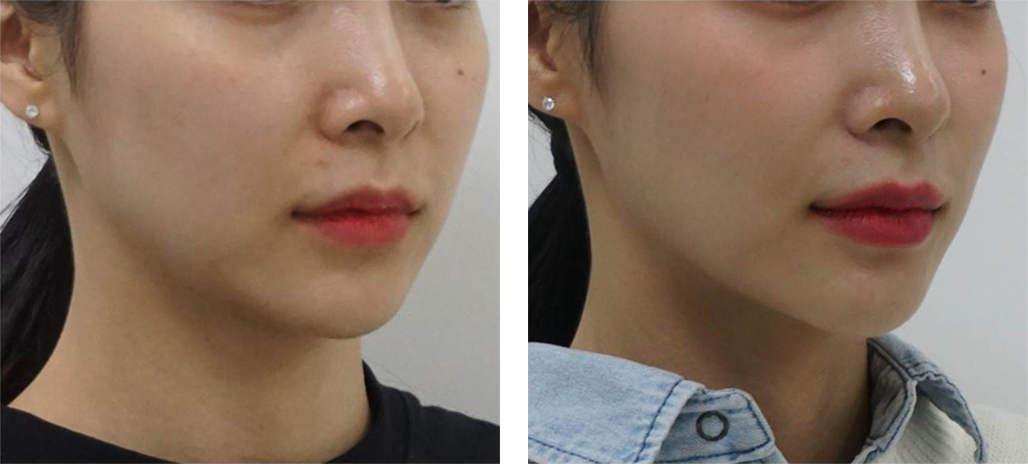 V Line Injection in Korea - Haru Clinic in Gangnam, South Korea