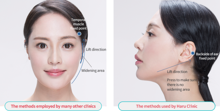 PDO Thread Lift in Korea - Haru Clinic in Gangnam, South Korea